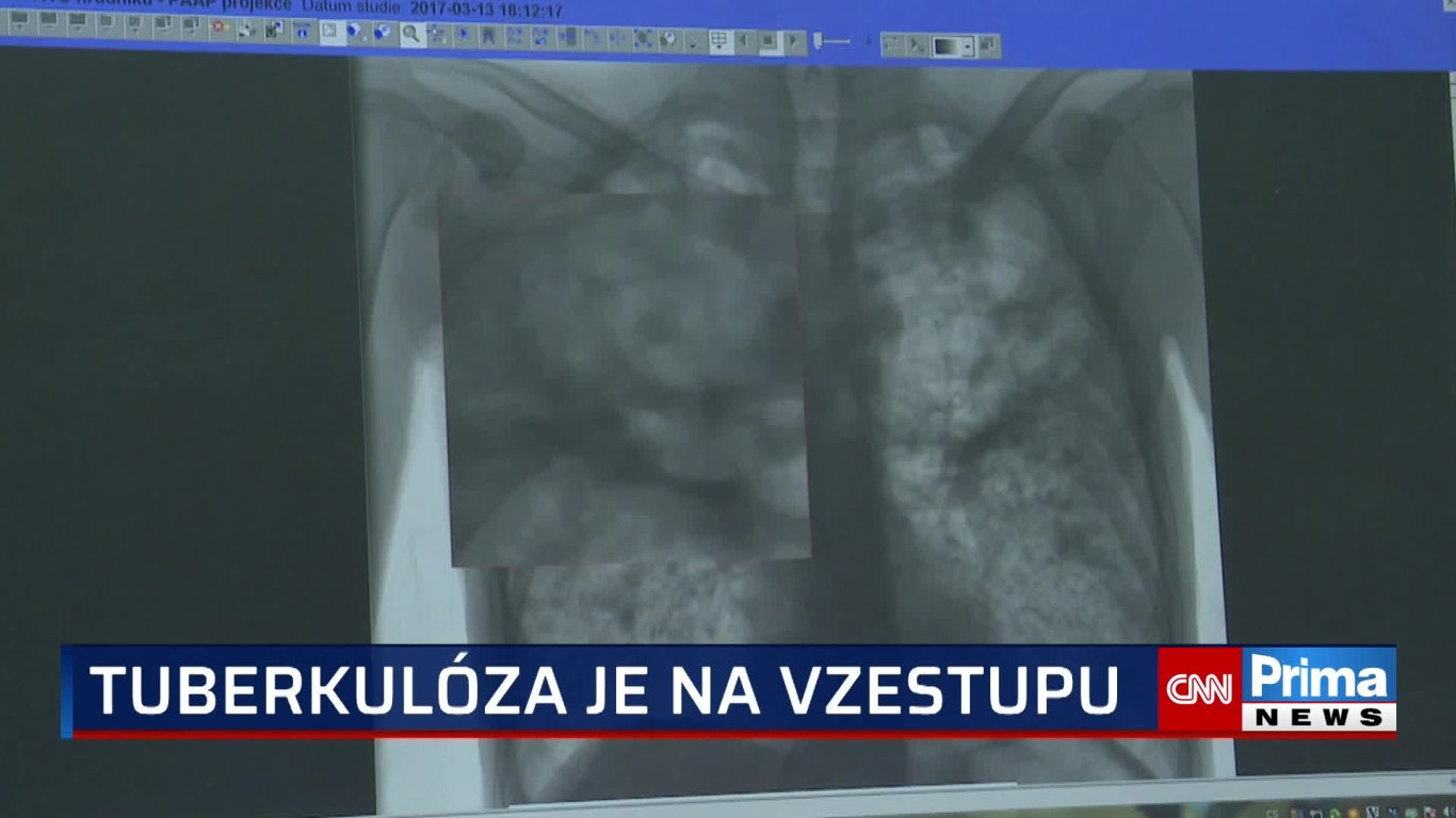 Tuberkulóza v Česku - CNN Prima NEWS