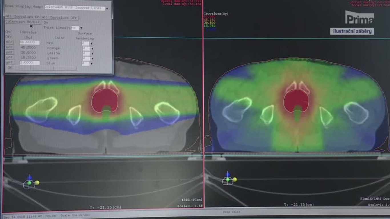 Prevence rakoviny prostaty - HLAVNÍ ZPRÁVY - CNN Prima NEWS