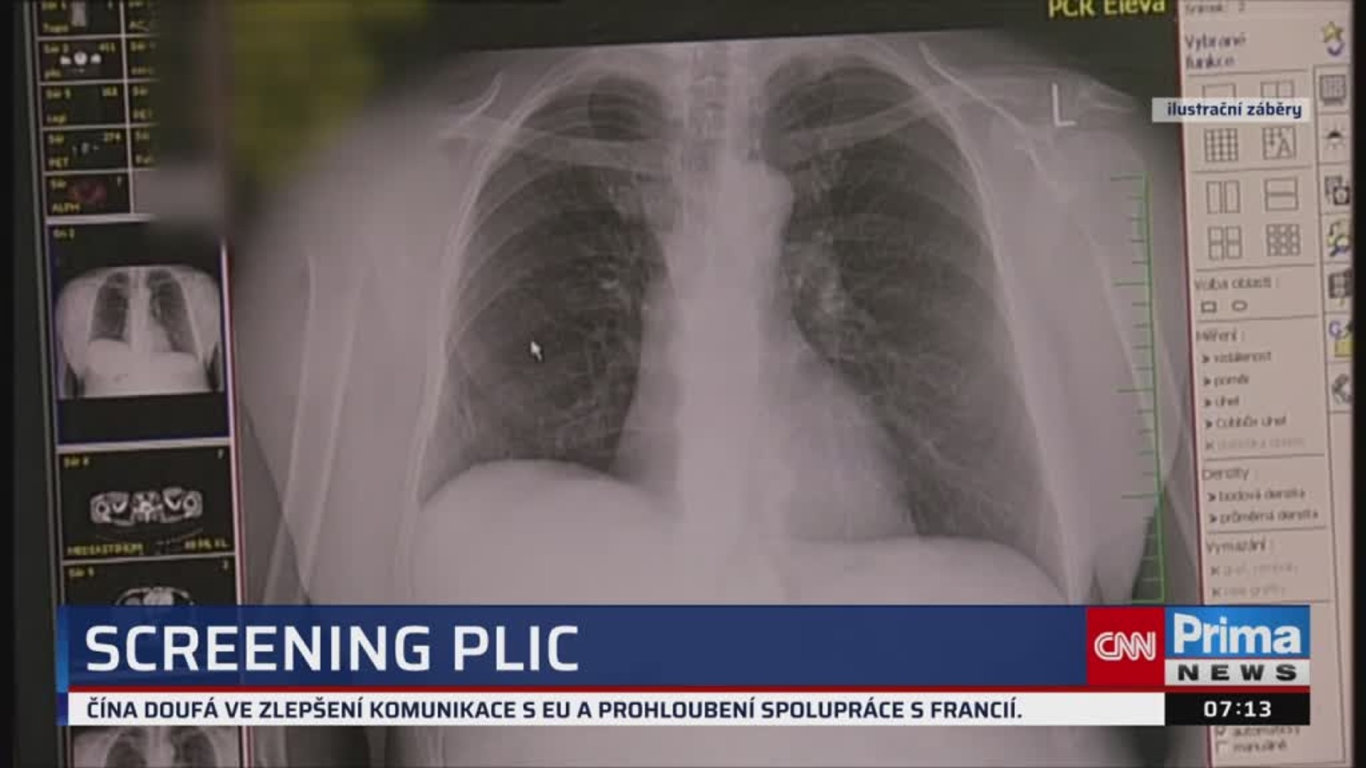Screening a rakovina plic - ZPRÁVY - CNN Prima NEWS